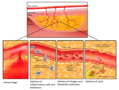 Effect Of Neovascularisation On The Plaque Morphology Download Scientific Diagram