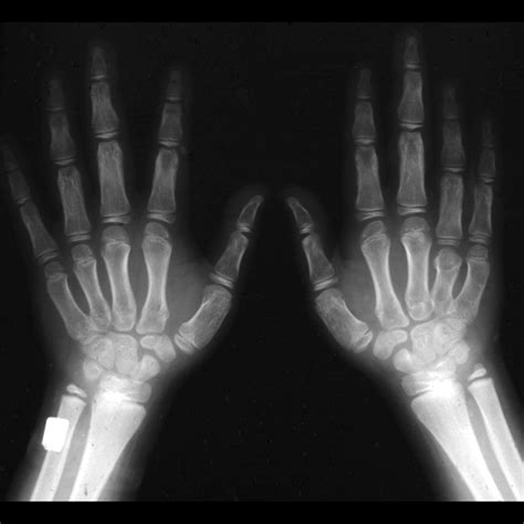 Pseudohypoparathyroidism
