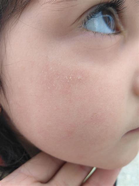 Сухая Кожа У Детей Фото — Картинки фотографии