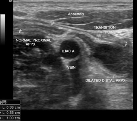 Normal Appendix Simply Radiology