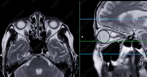 Image Of Mri Orbit Scan With Gadolinium Contrast In Normal Case