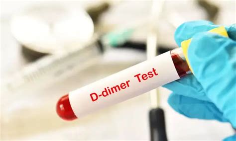 D Dimer Testing Effective For Screening Acute Aortic Syndromes With High Sensitivity And