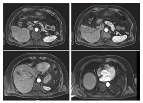 Liver Magnetic Resonance Download Scientific Diagram