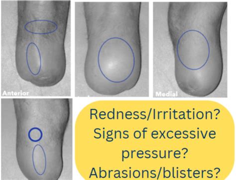 Prosthetics Surgery Flashcards Quizlet
