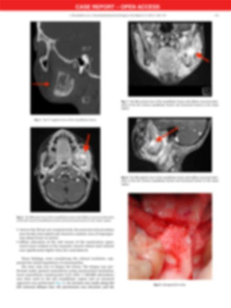 Solution Chronic Nonbacterial Osteomyelitis Involving The Mandible A