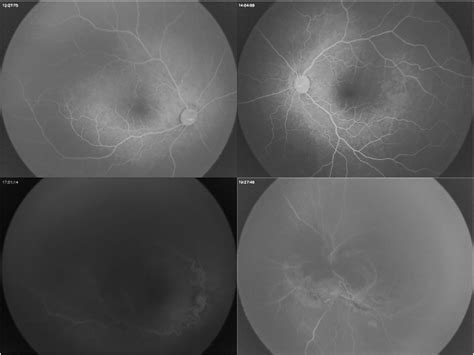 Fundus Fluorescein Angiography Ffa Of The Case 1 Upper Panels