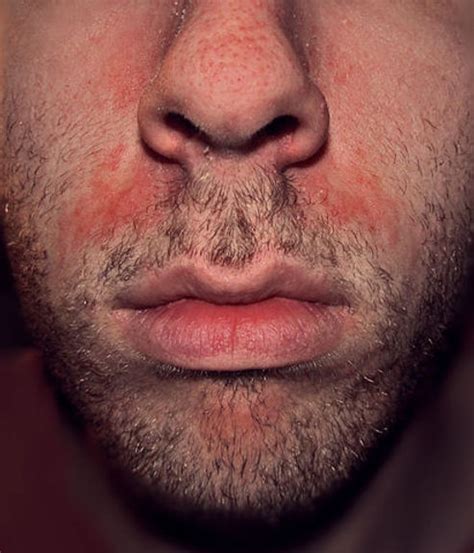 Parkinson S And Seborrheic Dermatitis