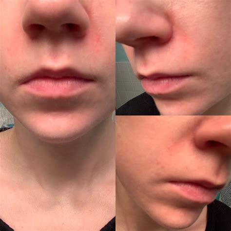 [skin Concerns] Persistent Redness Around My Nose Routine And More Info In Comments R