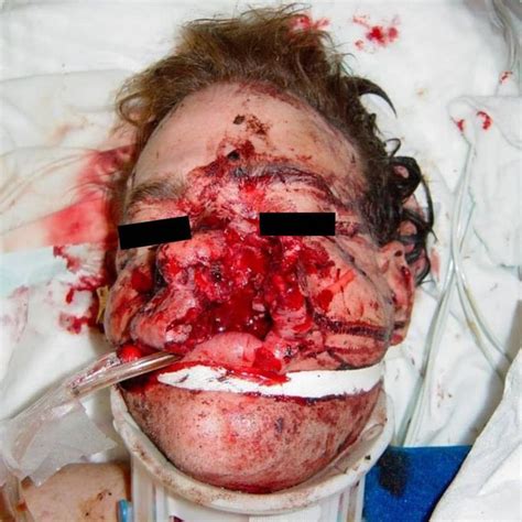 ⚠️ A Case Of A Gunshot Wound To The Face Medizzy
