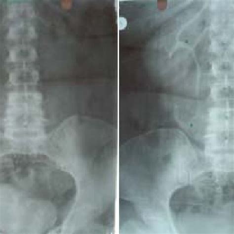 Ultrasonography Usg Showing Crossed Renal Ectopia Download
