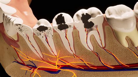 Los Dientes Molares Dañados Por La Caries Animación 3d Del Diente Médicamente Precisa Vídeo