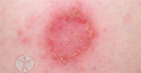 Nummular Dermatitis Discoid Eczema Image