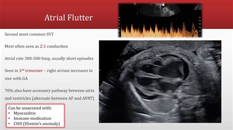 Fetal Arrhythmias Part 2 Assessing Tachyarrhythmia And Bradyarrhythmia Fetal Arrhythmias Part 2 Assessing Tachyarrhythmia And Bradyarrhythmia