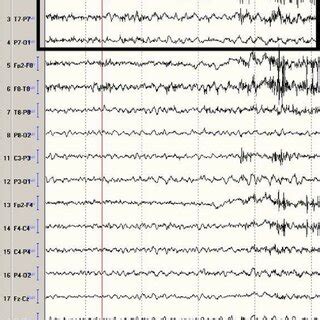 A MRI Of The Brain Showing Restricted Diffusion On Diffusion Weighted Download Scientific