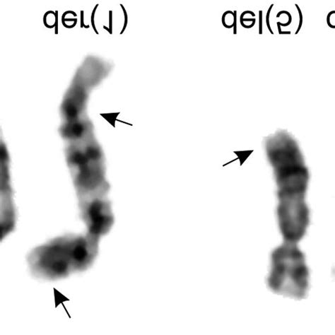 Cytogenetic Analysis Of The Chondrogenic Tumor Partial Karyogram