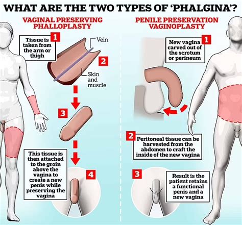 Non Binary People Getting Phalgina Surgery To Give Them Both Male And Female Sex Organs