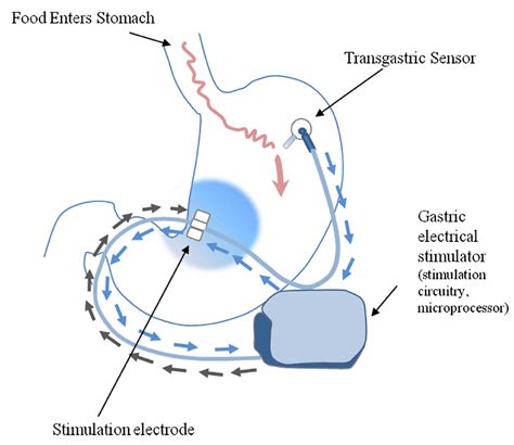 Gastric Pacemakers Questions And Answers In Mri