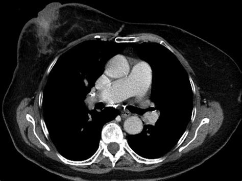 Radiation Associated Angiosarcoma Of The Breast A Clinicopathological