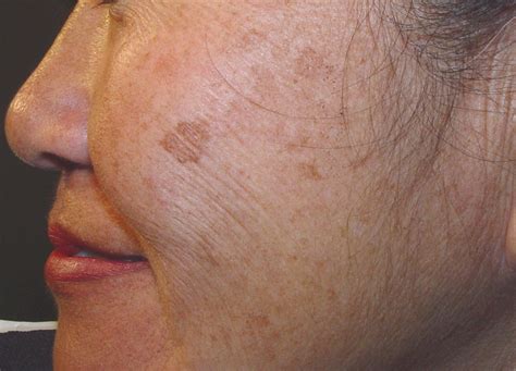 Hyperpigmentation Causes Risk Factors Treatment Options Healthworks Malaysia