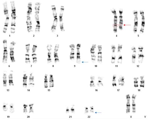 Prenatal Diagnosis Of Combined Maternal 4q Interstitial Deletion And Paternal 15q