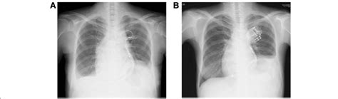 The Chest X Ray Images A Immediately After The Tcpc Conversion On The