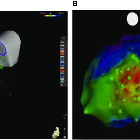 A Electroanatomic Bipolar Map With Evidence Of Posterior Basal