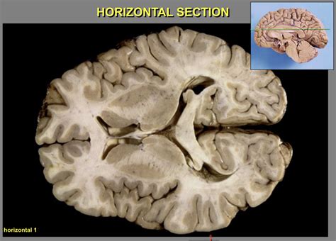 Anat 2160 Horizontal Section External Brain Label Review Diagram Quizlet