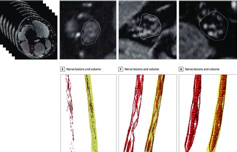 Segmentation Of Sciatic Nerve Hypointense Lesions In A T2 Weighed