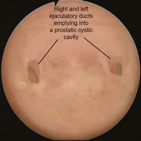 Ejaculatory Duct
