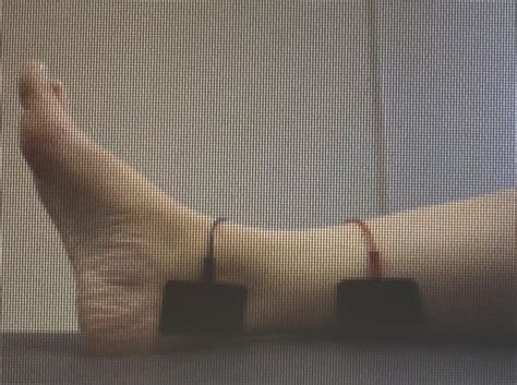 Tens Tibial Nerve Rprematureejaculation