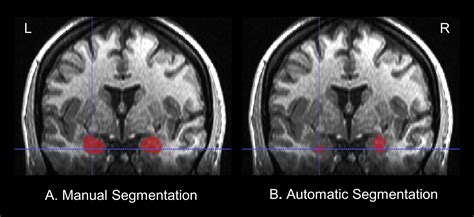 A Comprehensive Protocol For Manual Segmentation Of The Medial Temporal Lobe Structures Protocol