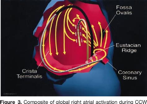 Figure 3 From Global Right Atrial Mapping Of Human Atrial Flutter The Presence Of Posteromedial