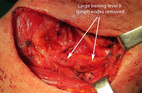 Marginal Mandibular Nerve Weakness Ramus Mandibularis Level I Neck Dissection Iowa Head