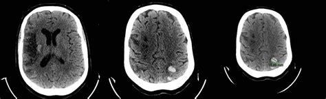 Ischemic Stroke From Non Bacterial Thrombotic Endocarditis Embolization In Li Fraumeni Syndrome