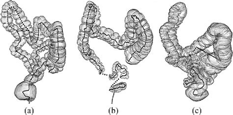 Figure 1 From Fully Automated Colon Segmentation For The Computation Of