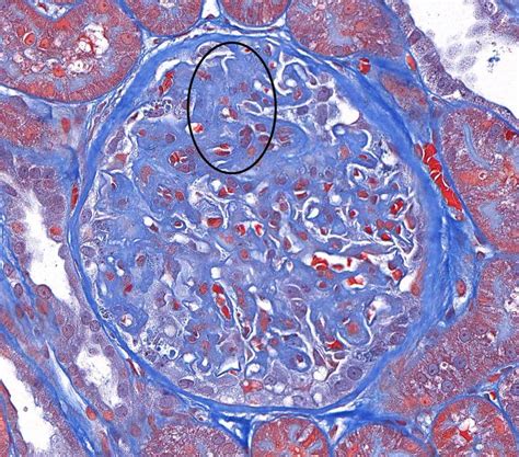 Focal Segmental Glomerulosclerosis Atlas Of Renal Lesions In