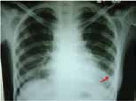 A Chest X Ray Pa View Patchy Pneumonia In Left Mid And Basal Zone