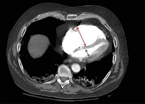 Multimodality Assessment Of Right Ventricular Strain In Patients With