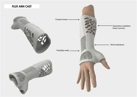 Custom Orthopaedic Arm Cast Design Behance