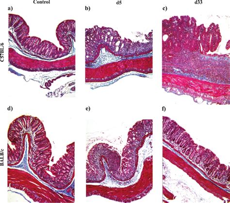 Increased Deposits Of Collagen In Acute And Chronic Inflamed Colon
