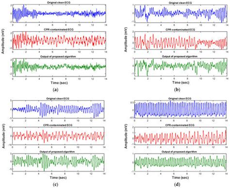 Sensors Special Issue Novel Wearable Ecg Sensors And Signal Analysis Of Ecg Data