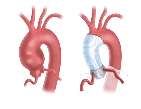 Aortic Root Dilation