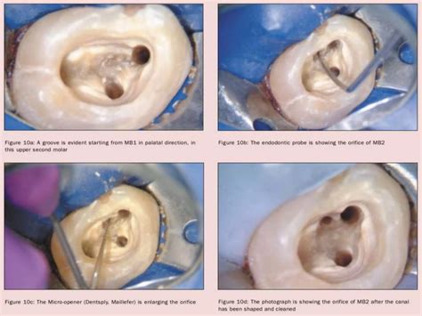 Operating Microscope In Endodontics Pptx