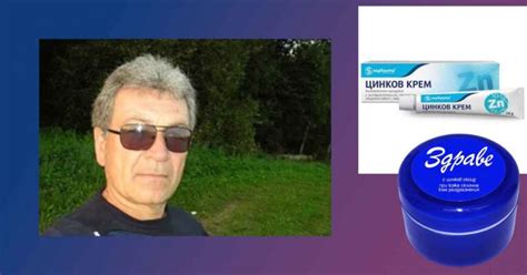 Домашен крем за атопичен дерматит 15 идеи Лечител Net