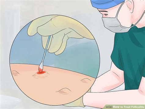 3 Ways To Treat Folliculitis Wikihow