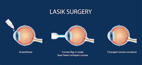 The Process Of Laser Eye Surgery Lasik Vision Correction For
