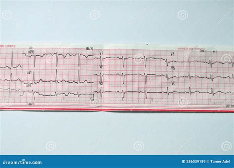 An Electrocardiograph Ecg A Chart That Draws The Electricity Of The Heart And Gives An Idea On