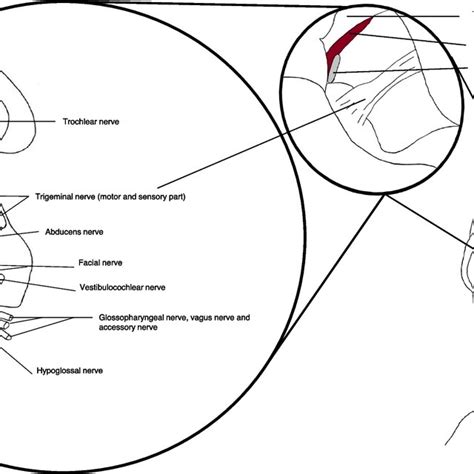 Illustration Of The Principles Of Microvascular Decompression And The