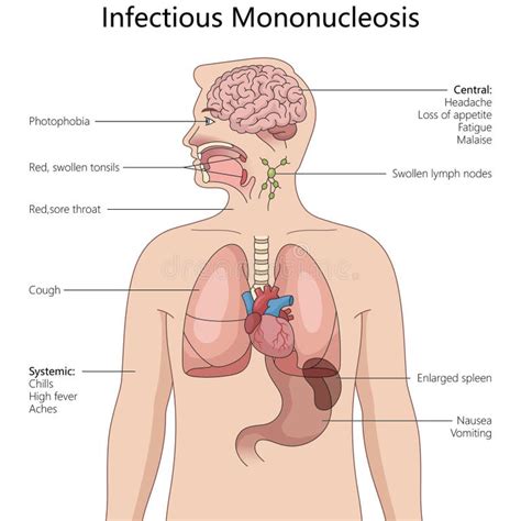 Symptoms And Effects Of Infectious Mononucleosis Stock Illustration