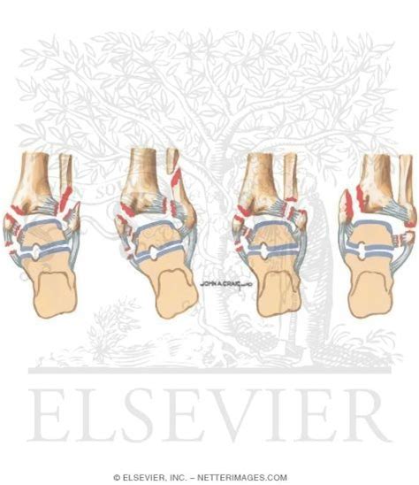 Lauge Hansen Classification Of Ankle Fracture